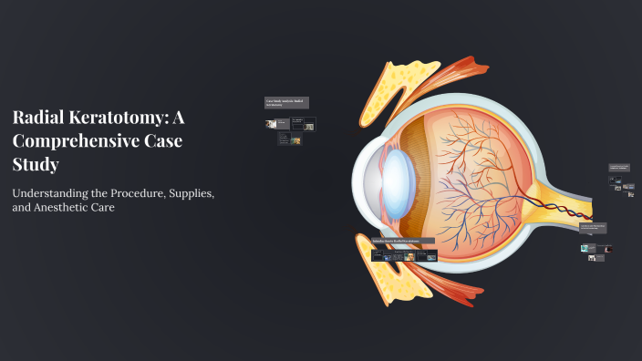 Radial Keratotomy: A Comprehensive Case Study by Aaliyah Oates on Prezi