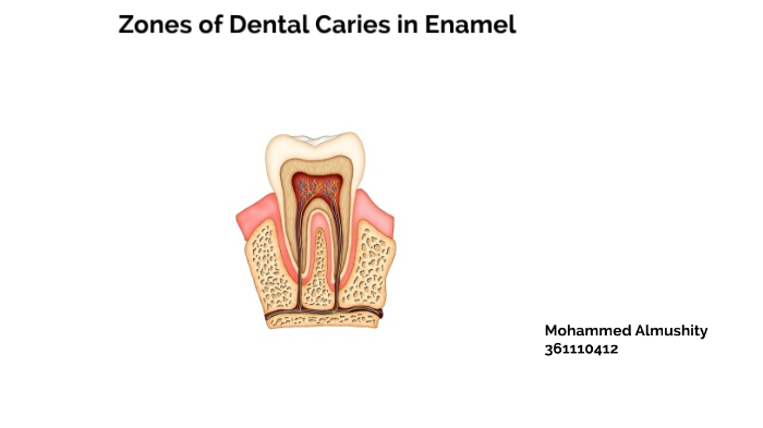 Zones of Dental Caries in Enamel by Mohammed Almushity on Prezi