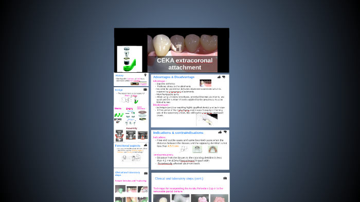 CEKA extracoronal attachment by dr arwa on Prezi