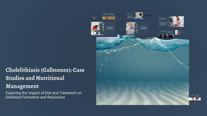 Cholelithiasis (Gallstones): Case Studies and Nutritional Management by ...