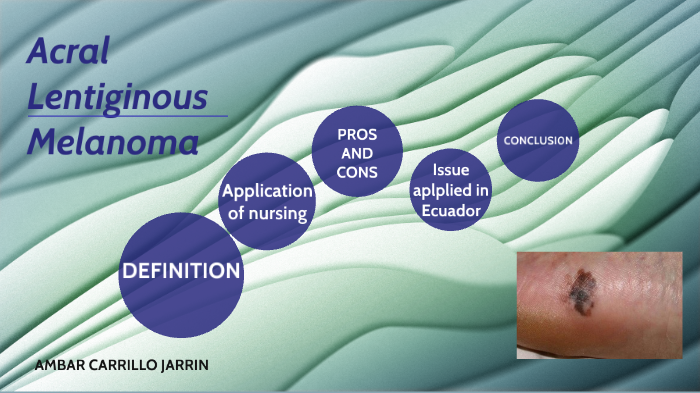 acral lentiginous melanoma by A. Alexandra C on Prezi
