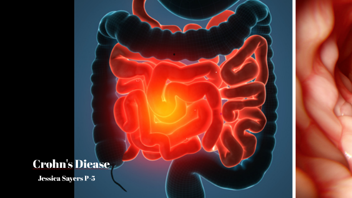 Crohn's Diease by Jessica Sayers