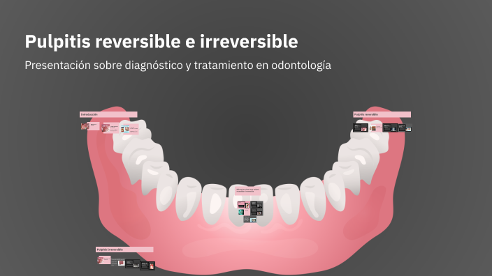 Pulpitis reversible e irreversible by Sergio Saúl Sotelo García on Prezi