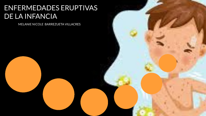 ENFERMEDADES ERUPTIVAS DE LA INFANCIA by Melanie Barrezueta on Prezi
