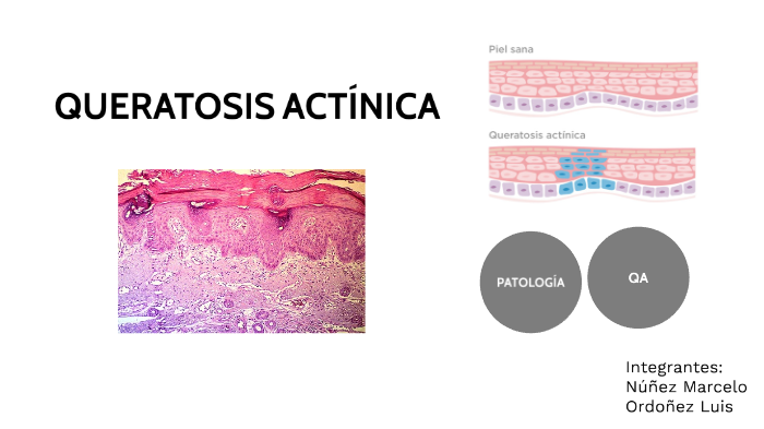 Queratosis Actinica by Marcelo Núñez on Prezi