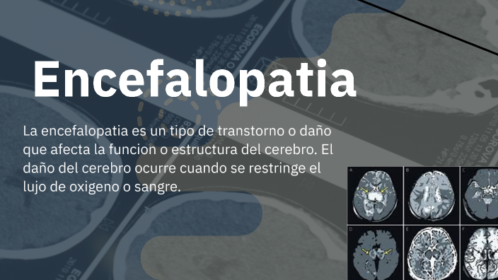 Encefalopatía by Paola Aquino Salazar on Prezi