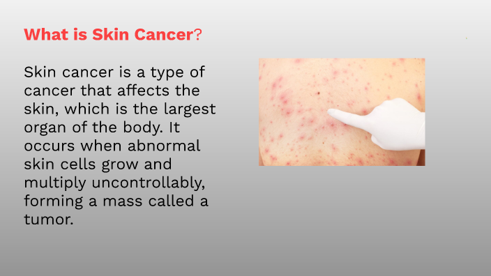 Types of Skin Cancer There are several types of skin cancer, including ...