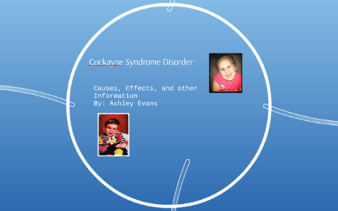 Cockayne Syndrome by ashley e on Prezi
