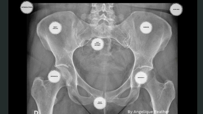 Pelvis X-ray Reject Analysis by on Prezi