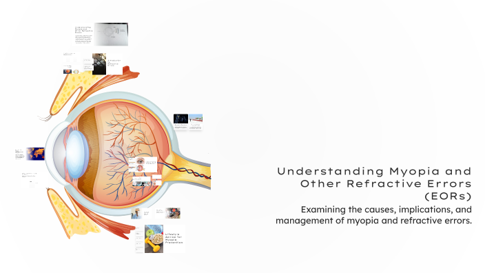 Understanding Myopia and Other Refractive Errors (EORs) by Jenn Viñola ...