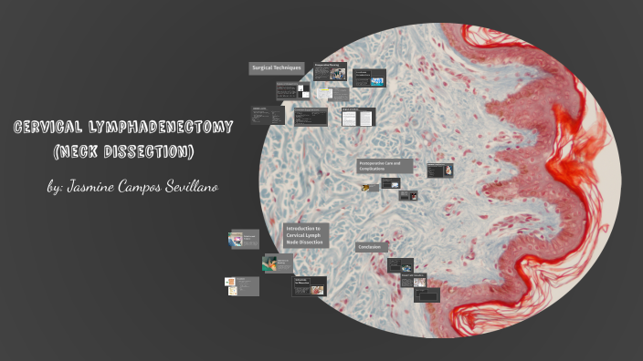 Cervical Lymph Node Dissection by Jasmine Campos Sevillano on Prezi