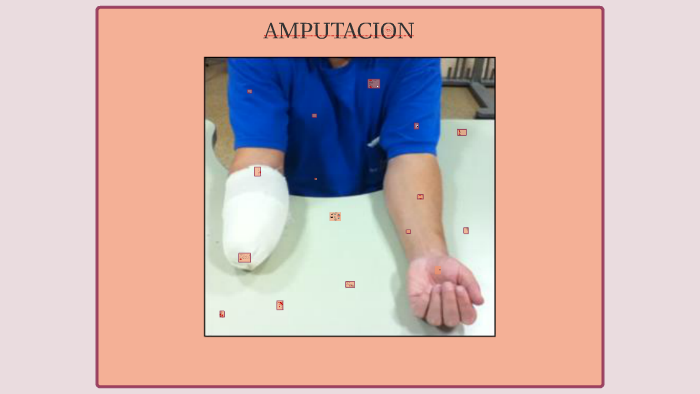 AMPUTACION by Rafael Moreira on Prezi