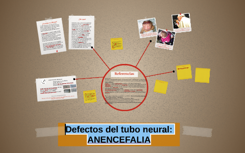 Defectos del tubo neural: ANENCEFALIA by Gladys Hernández Jiménez on Prezi
