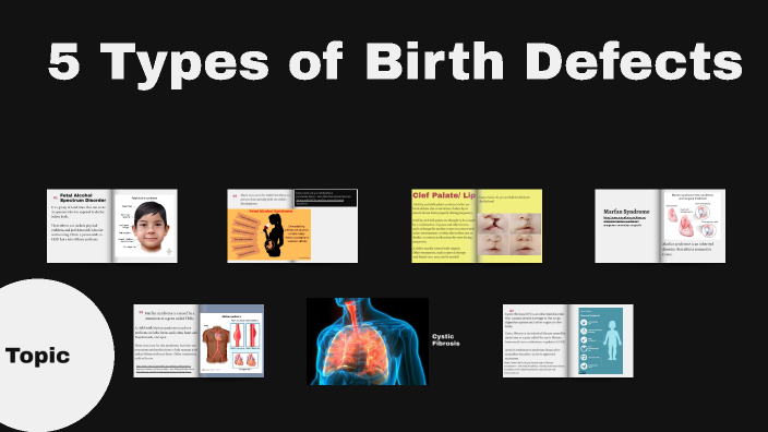 5 Types of Birth Defects by Bianca Gordon on Prezi