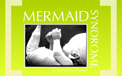 Mermaid Syndrome by Rachel MacDonald on Prezi