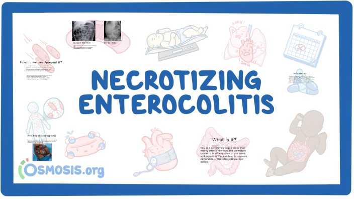 Necrotizing Enterocolitis by Quincy English on Prezi