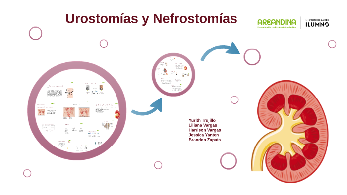 Urostomías y Nefrostomías by HARRISON VARGAS on Prezi