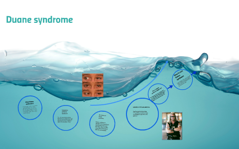 Duane syndrome by Russell Hopkin on Prezi