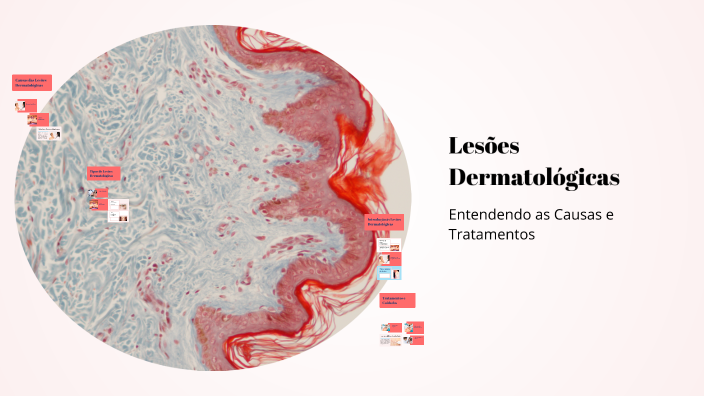 Lesões Dermatológicas by Giovanna Vitória César Jordão on Prezi