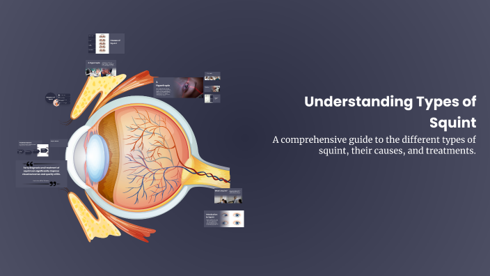 Understanding Types of Squint by محمد عماد محمد عماد شاني on Prezi