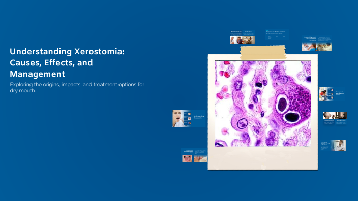 Understanding Xerostomia: Causes, Effects, and Management by Anita Velasquez on Prezi