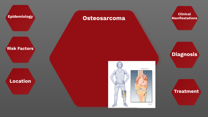 Bone Cancer by Connor Haxton on Prezi