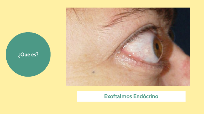 Exoftalmos endócrino by rodrigo santiz on Prezi