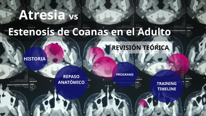 Atresia Vs Estenosis de Coanas by evy lara on Prezi