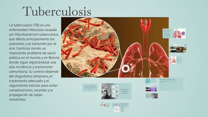 Tuberculosis: Definición, Diagnóstico y Tratamiento by Madeline J ...