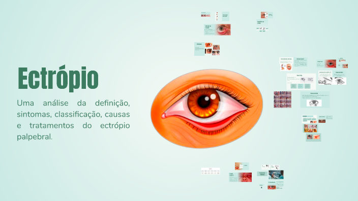 Ectrópio: Definição e Classificação by Angélica Sapori on Prezi