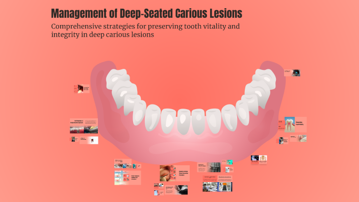 Management of Deep-Seated Carious Lesions by ali adil on Prezi