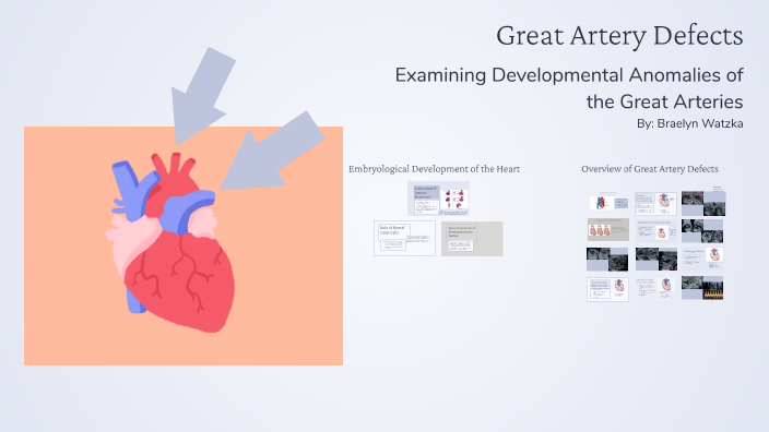 Great Artery Defects by Braelyn Watzka on Prezi