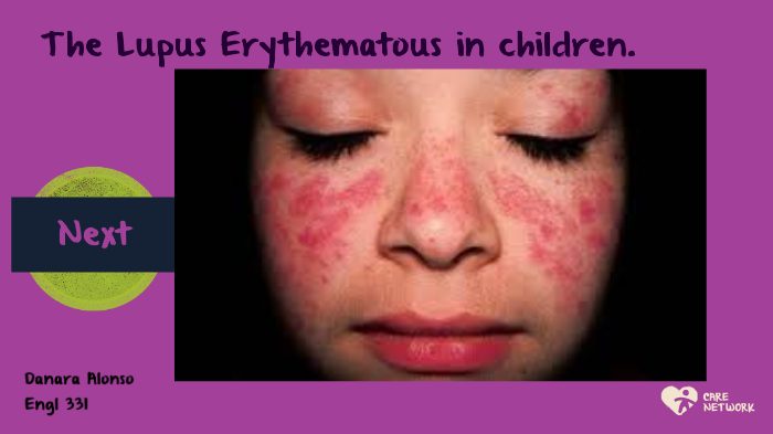 The Lupus Erythematous in children by Danara Alonso on Prezi