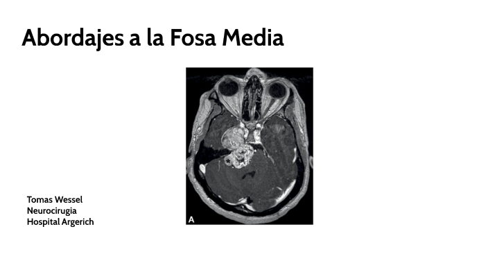 Abordajes a la Fosa Media by Tomas Wessel on Prezi