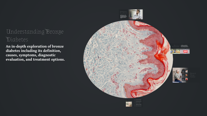 Understanding Bronze Diabetes by Lukaku Mm on Prezi