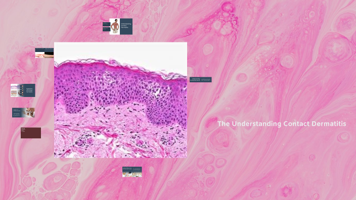 Understanding Contact Dermatitis: Types, Symptoms, and Treatments by ...