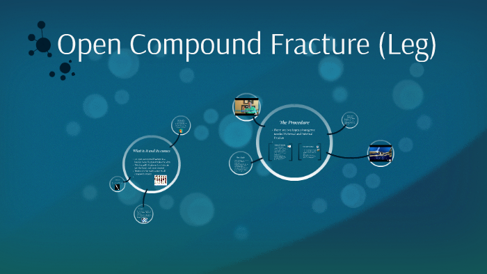 Open Compound Fracture (Leg) by Isaiah Merriwether on Prezi