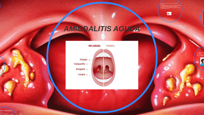 AMIGDALITIS AGUDA by on Prezi