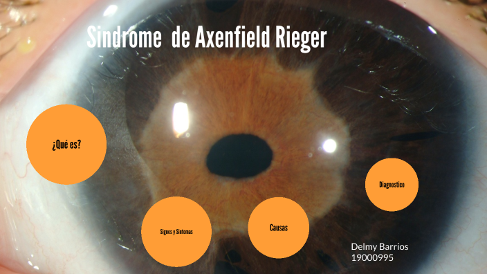 Síndrome de Axenfeld-Rieger by Delmy Barrios on Prezi