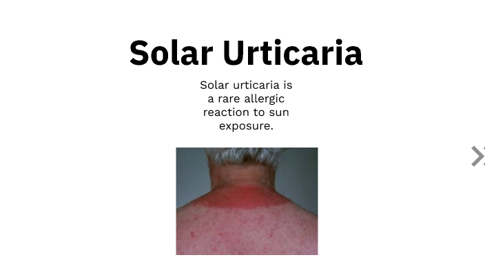 Solar Urticaria by Abram Bryant on Prezi