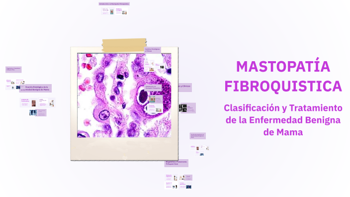 MASTOPATÍA FIBROQUISTICA by aide cardenas salgado on Prezi