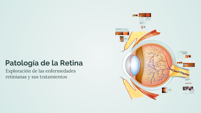 Patología de la Retina by Salinas Angel Irvin Alberto on Prezi