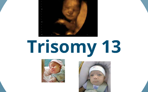 Trisomy 13 Baby
