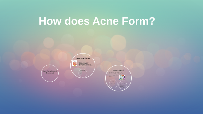 How does acne form and treatment by Abby Wetzel on Prezi