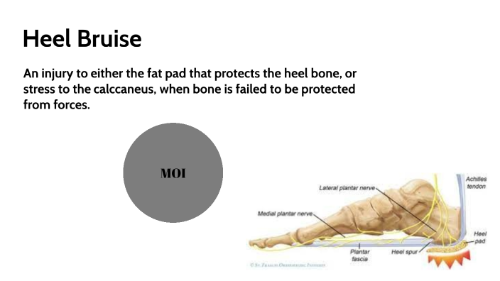 Heel Bruise by Cherilyn Purba on Prezi