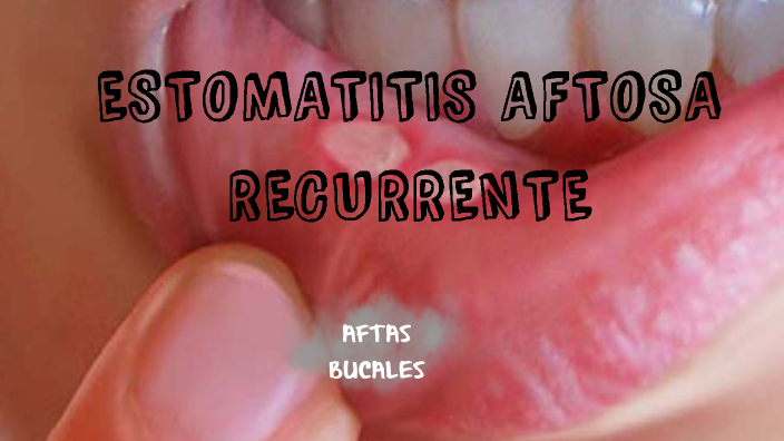 ESTOMATITIS AFTOSA RECURRENTE by Karol katy Atoche floreano on Prezi