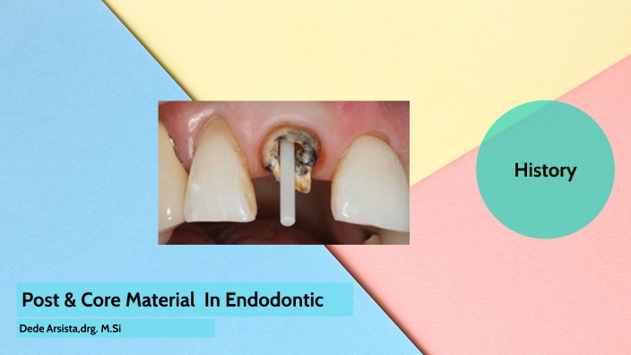 Endo post core Material (New) by Dede Arsista