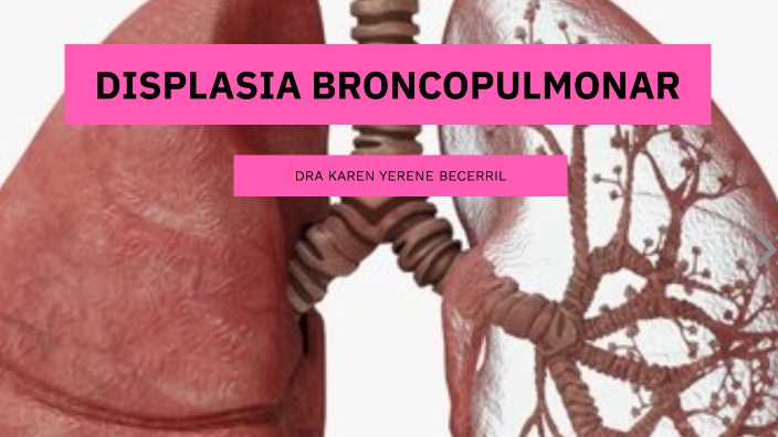 DISPLASIA BRONCOPULMONAR by KAREN YERENE on Prezi