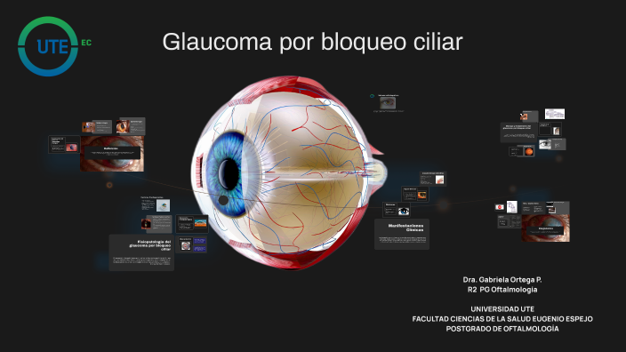 Glaucoma por bloqueo ciliar by Gabriela Ortega on Prezi