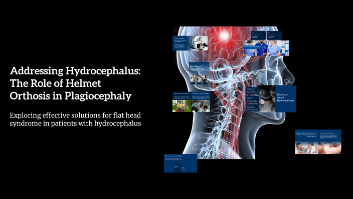 Addressing Hydrocephalus: The Role of Helmet Orthosis in Plagiocephaly ...